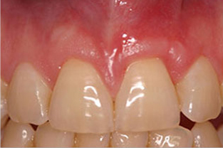 Periodontal Case Studies | Houston TX | J. Robert Friedberg